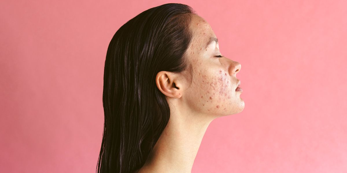 Aklief vs. Tretinoin – Choosing the Ideal Topical Retinoid for You
