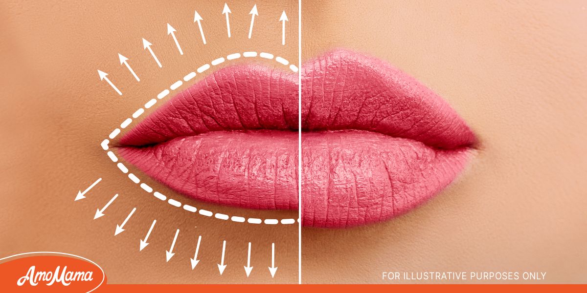 Lip Flip: The Benefits of the Procedure & the before and after Results
