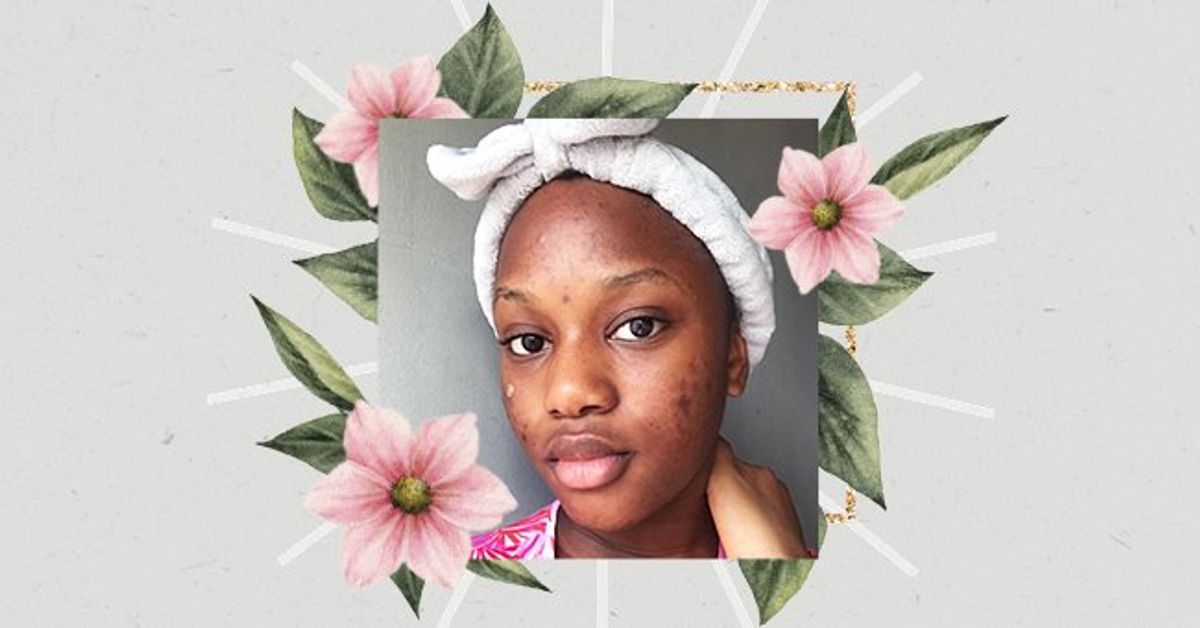 A Comprehensive Guide To Fading Acne Scars