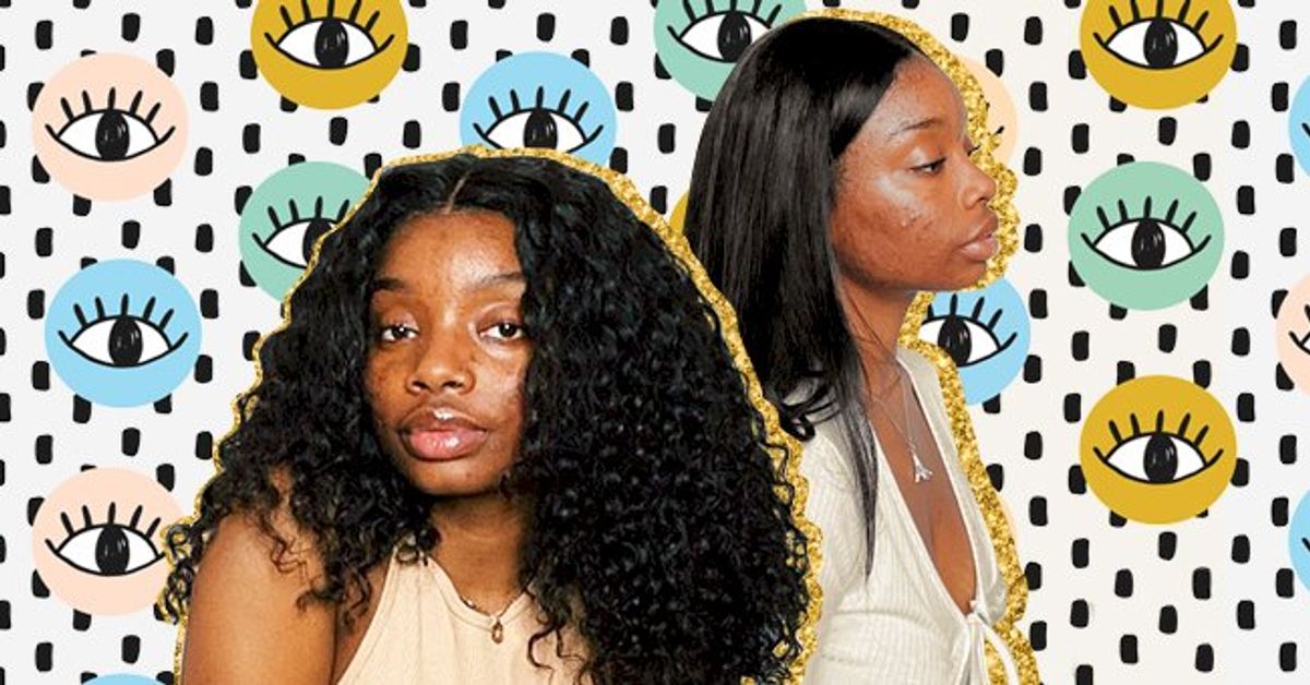'Acne Positivity': The Do's & Don't Of How To Deal With Acne
